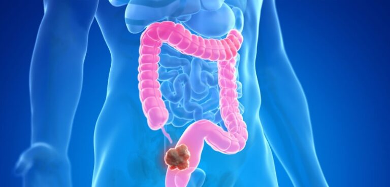 Colon Cancer on the rise in young adults within the U.S. - NYCTastemakers